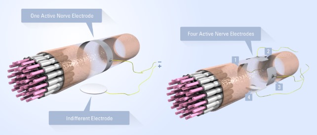 phrenic nerve stimulation